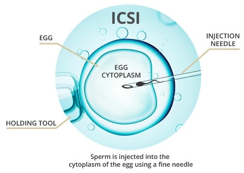 Intracytoplasmic spern injection (ICSI), defined
